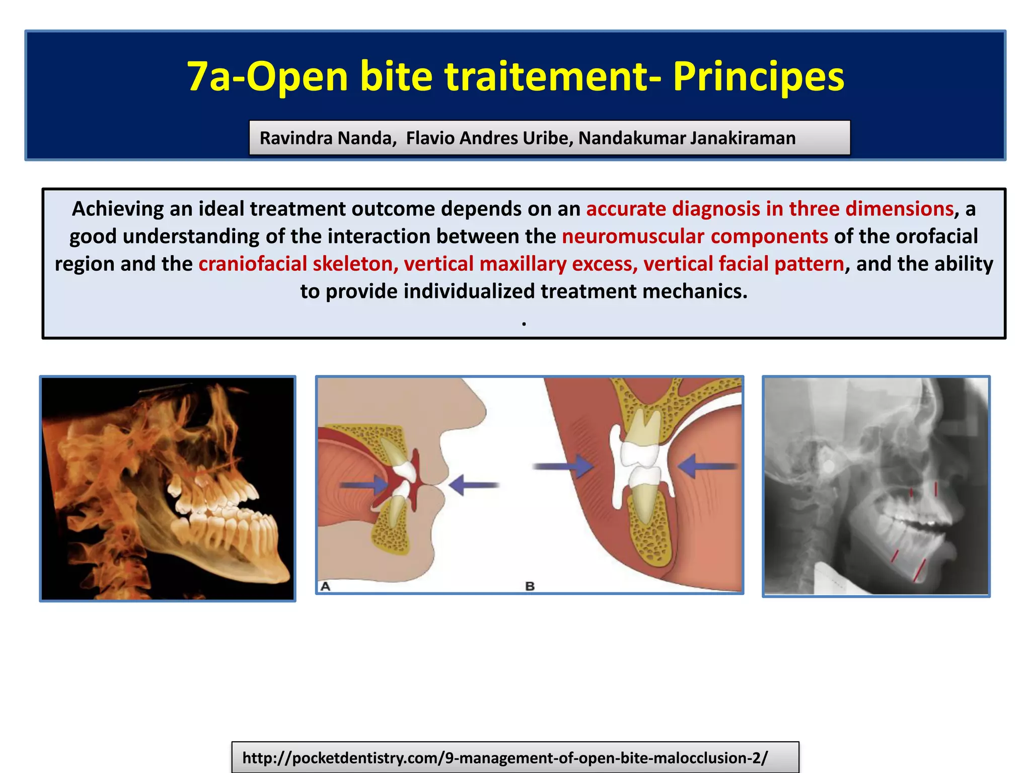 Pdf- open-bite-malocclusion | PDF
