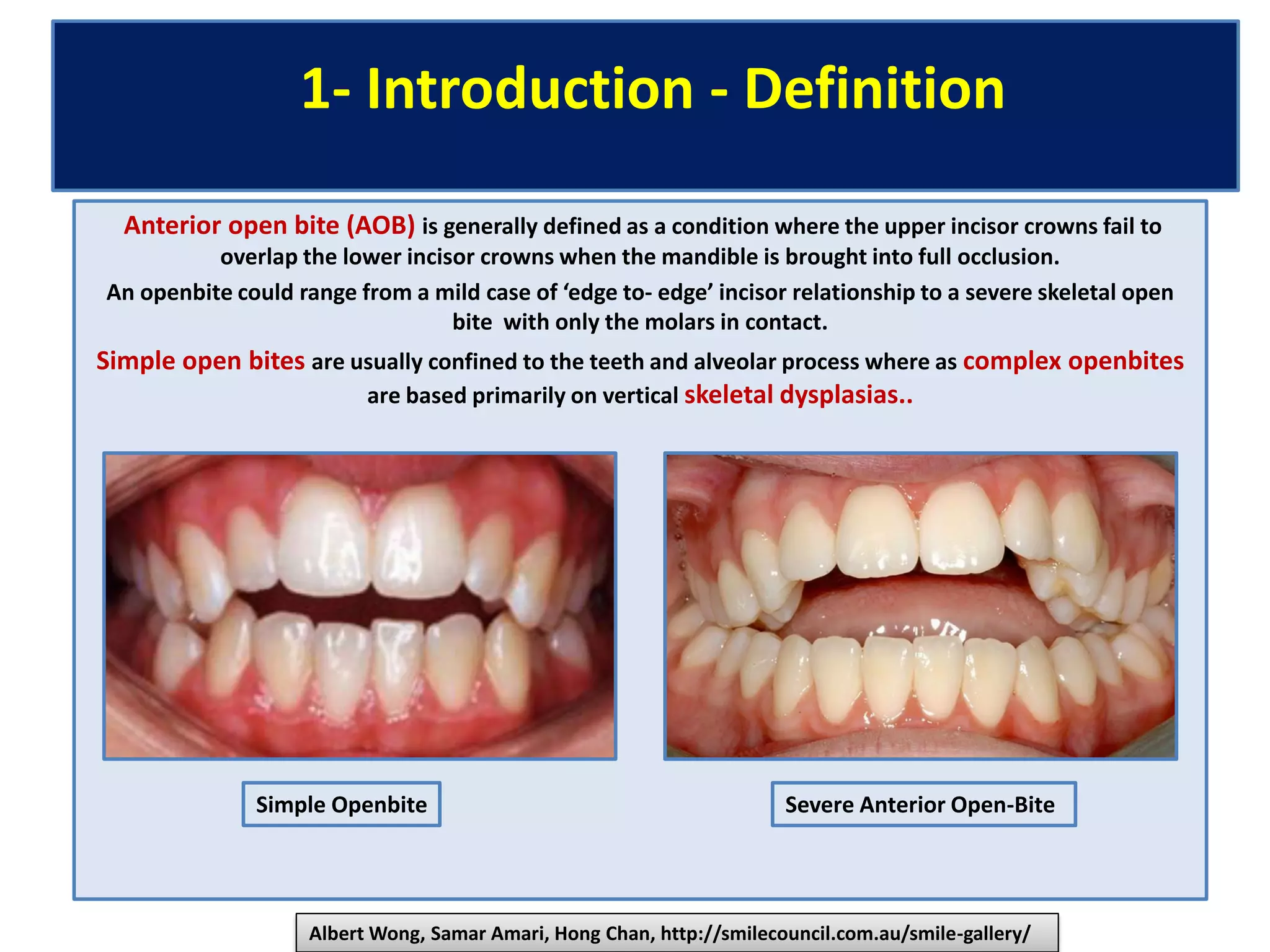 Pdf- open-bite-malocclusion | PDF