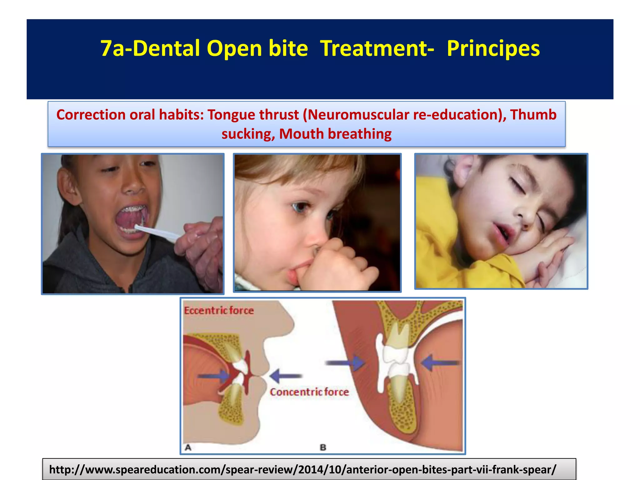 Pdf- open-bite-malocclusion | PDF