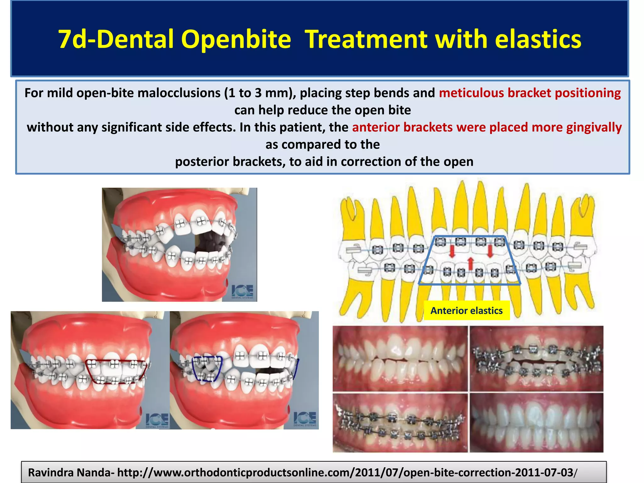 Pdf- open-bite-malocclusion | PDF