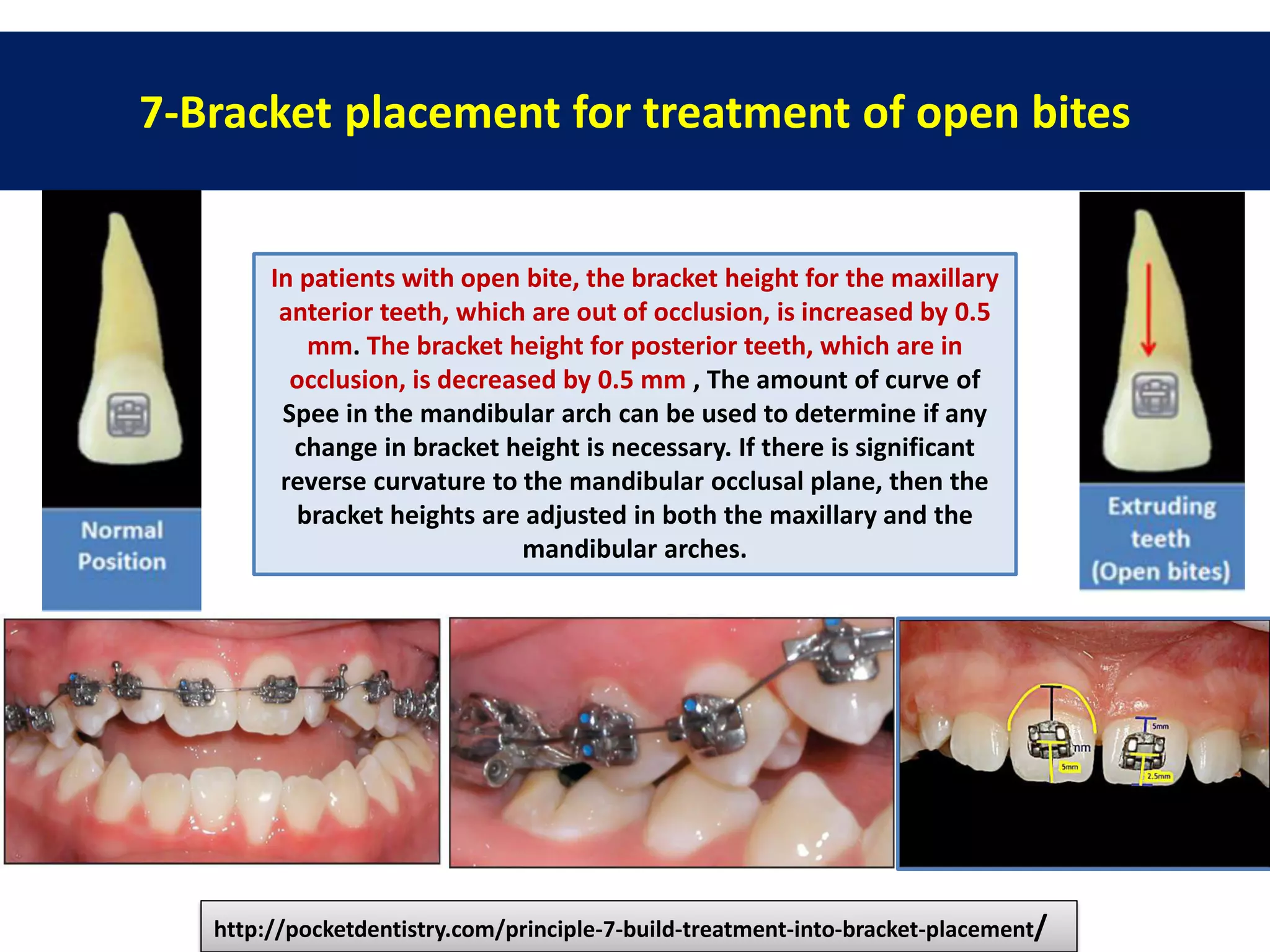 Pdf- open-bite-malocclusion | PDF