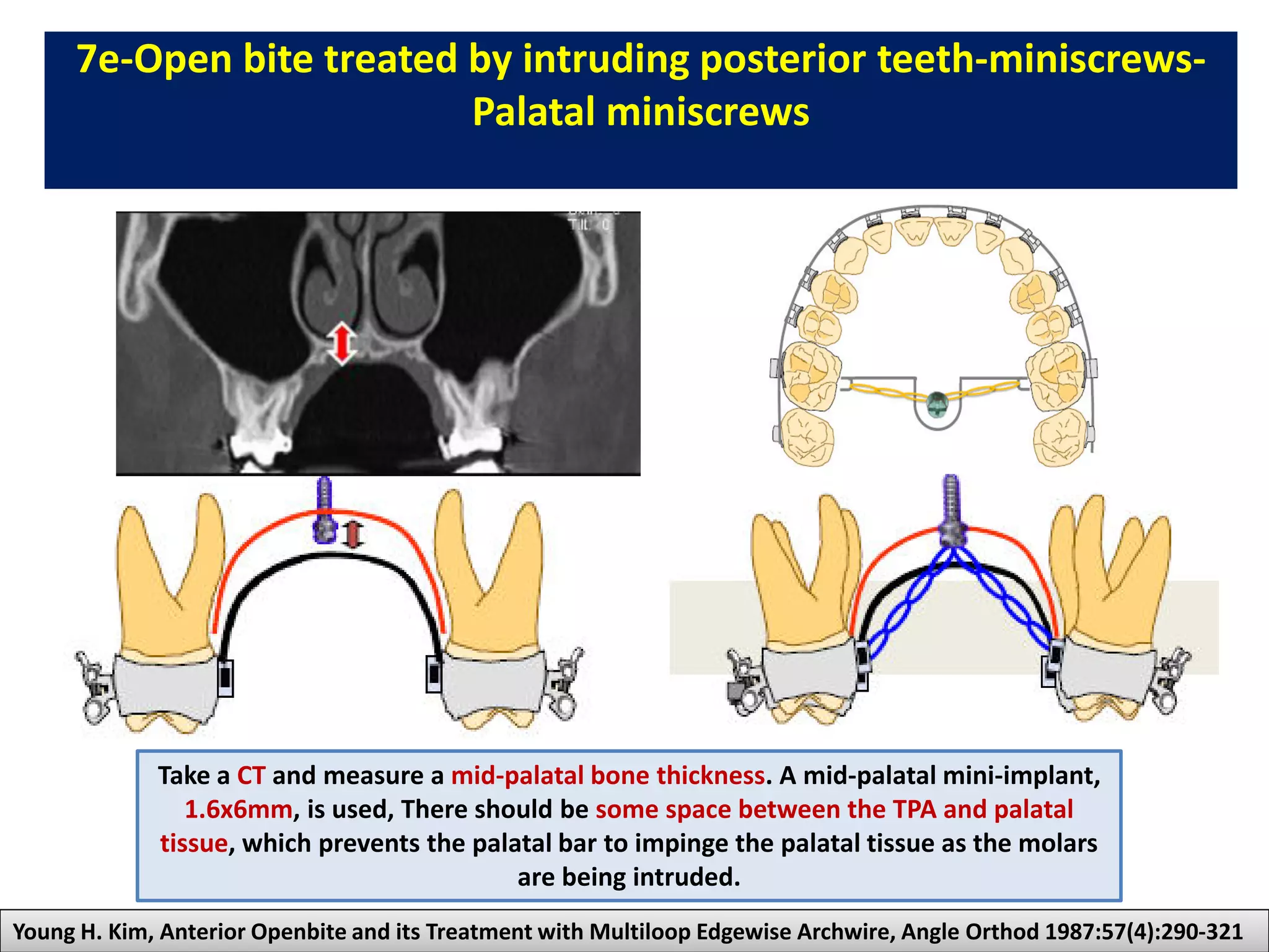Pdf- open-bite-malocclusion | PDF