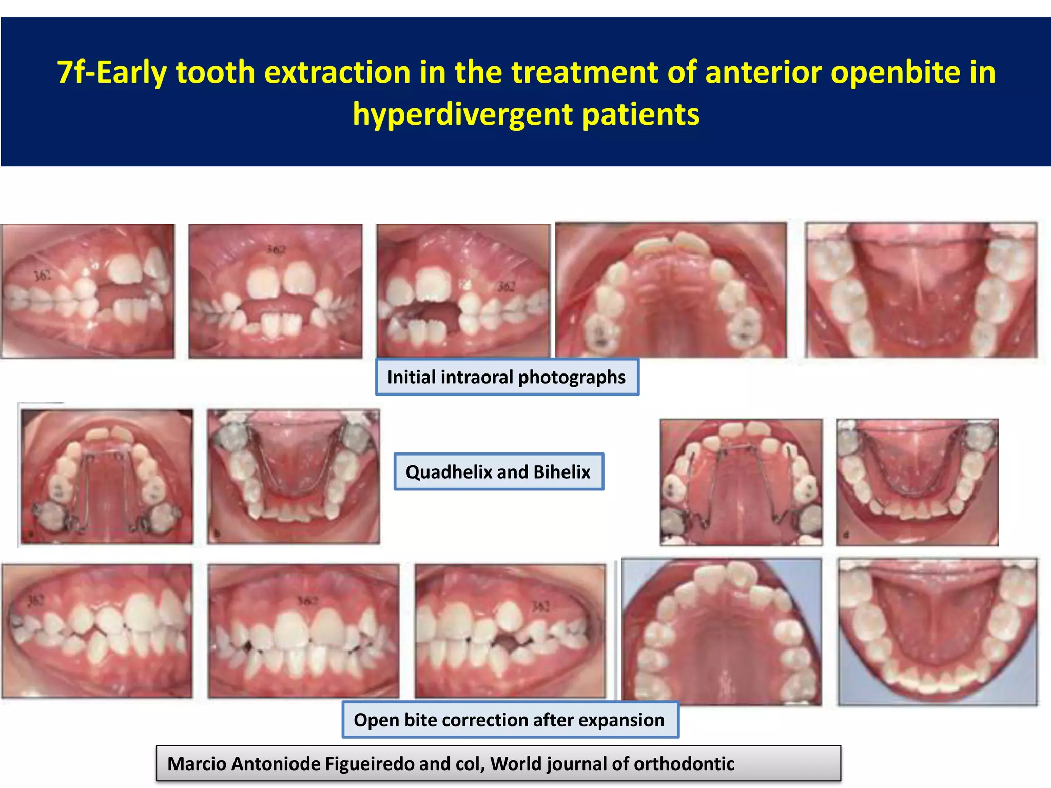Pdf- open-bite-malocclusion | PDF
