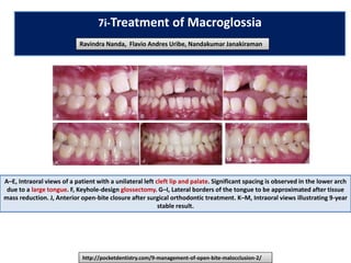 Macroglossia Open Bite