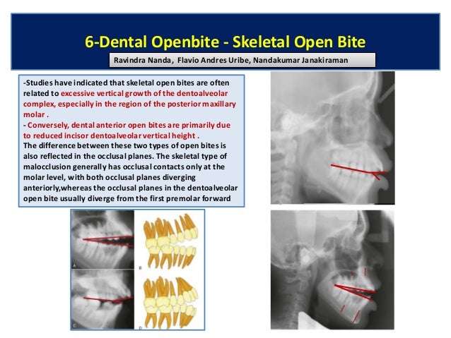 Pdf- open-bite-malocclusion