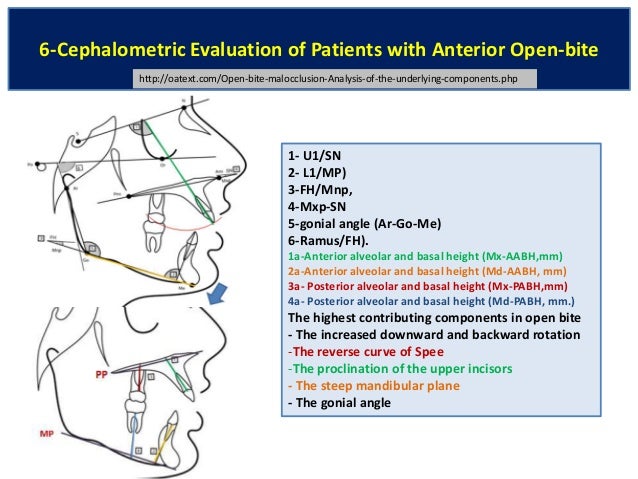 Pdf- open-bite-malocclusion