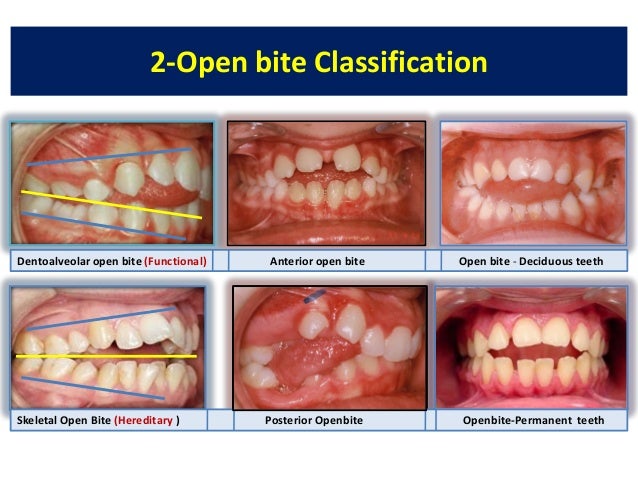 Pdf- open-bite-malocclusion
