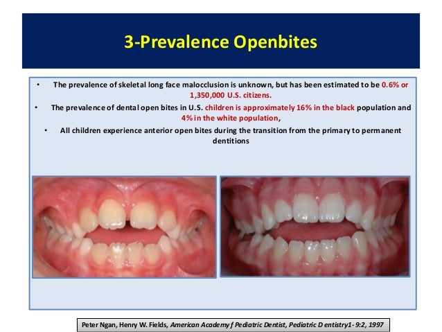 Pdf- open-bite-malocclusion