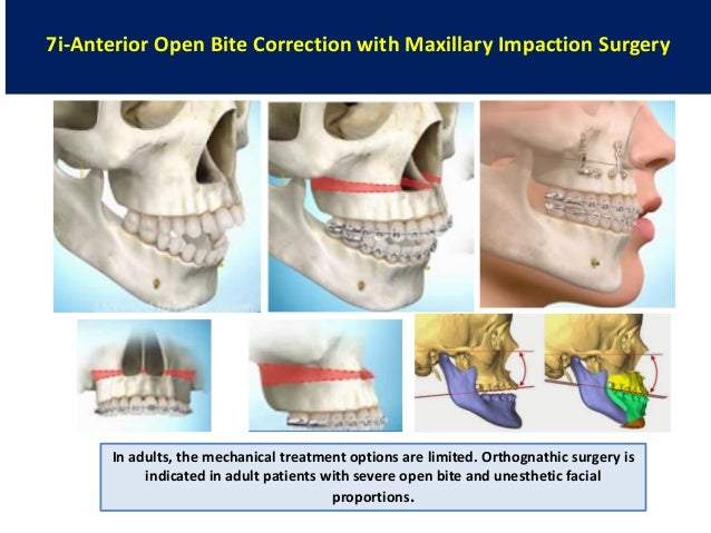 Pdf- open-bite-malocclusion