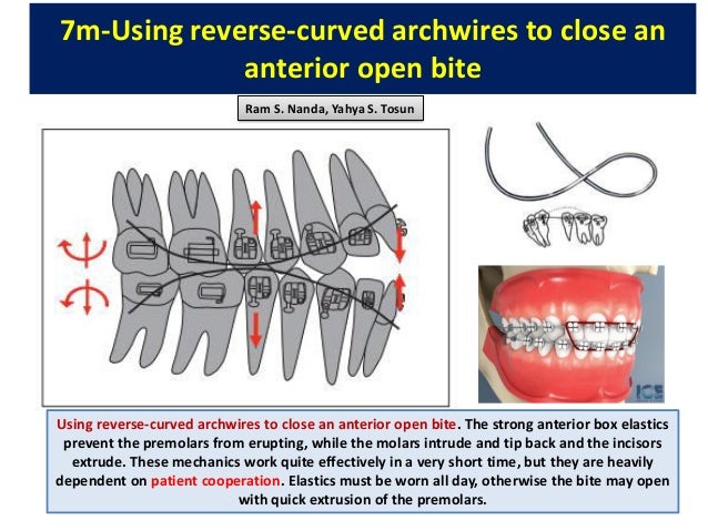 Pdf- open-bite-malocclusion
