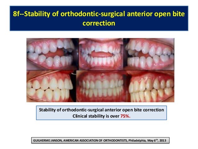 Pdf- open-bite-malocclusion