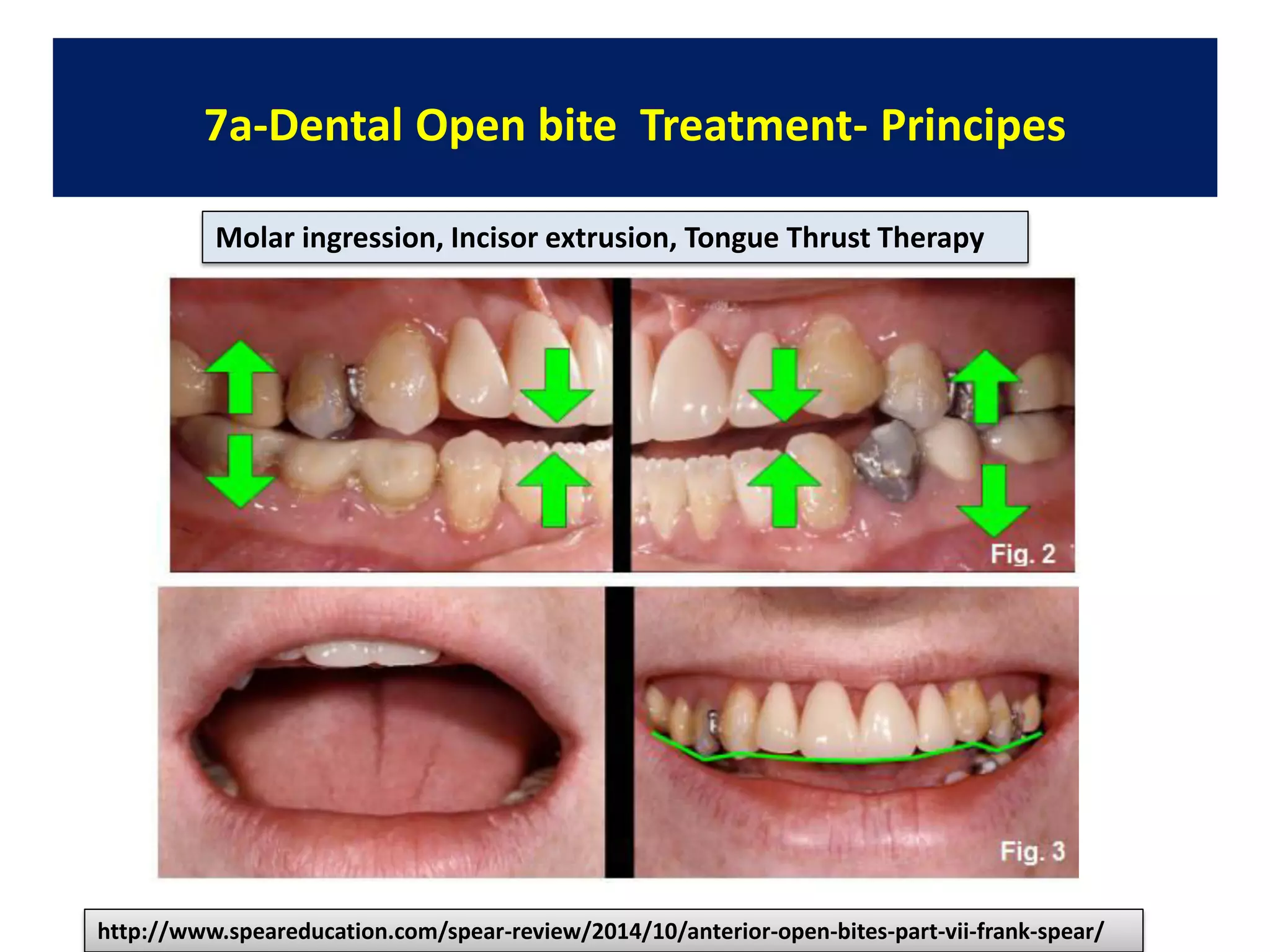 Pdf open-bite-malocclusion-150510202847-lva1-app6892 (3) | PPT