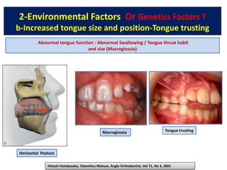 Macroglossia Open Bite