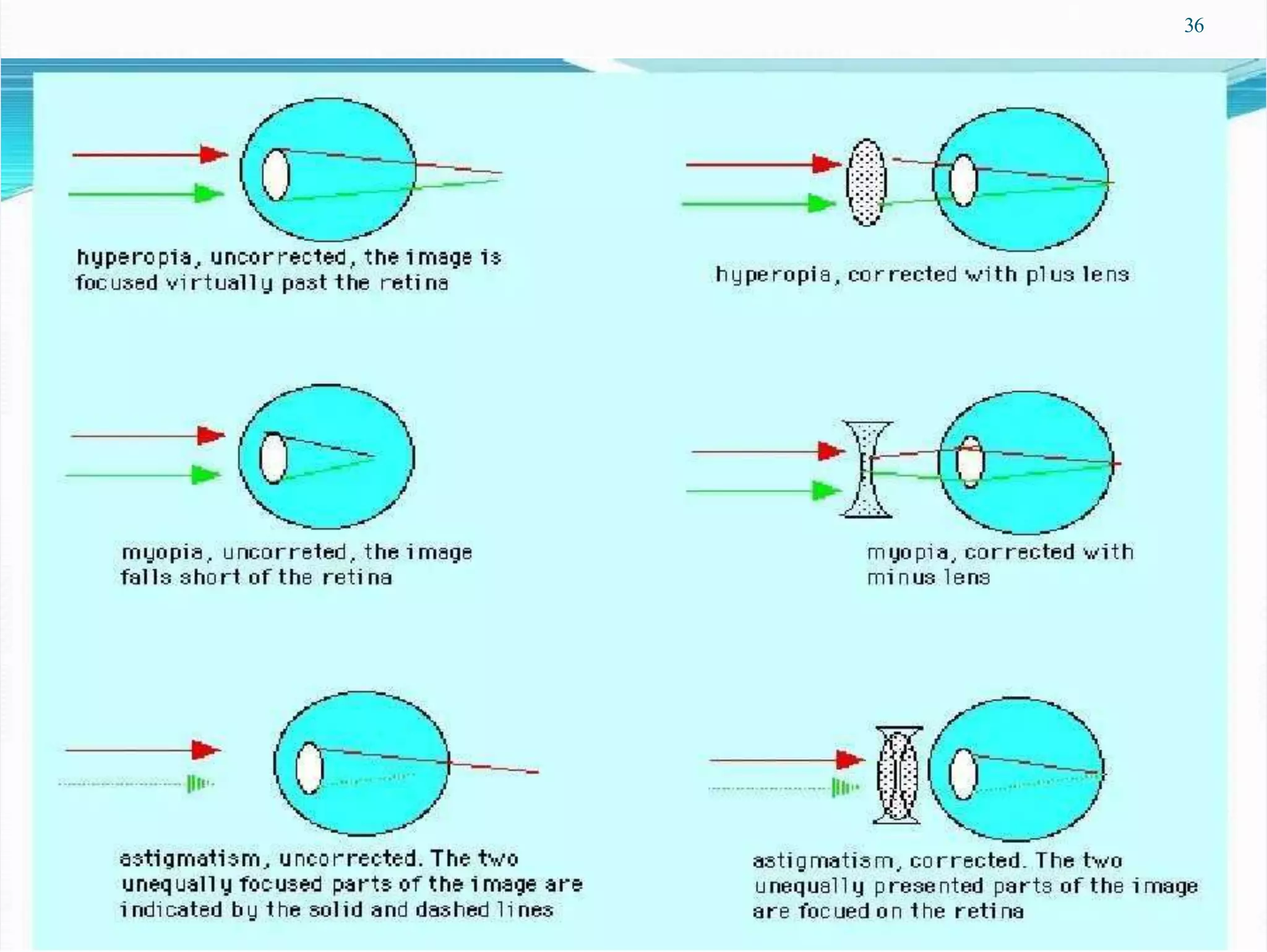 pdf-tbl-1-refractive-error-slides.pptx