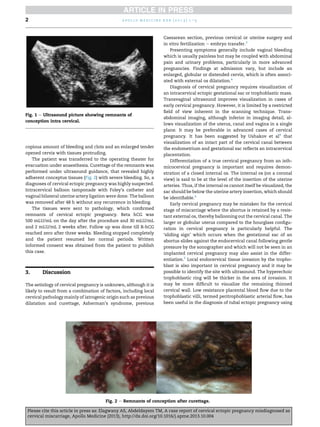 A case report of cervical ectopic pregnancy misdiagnosed as cervical ...