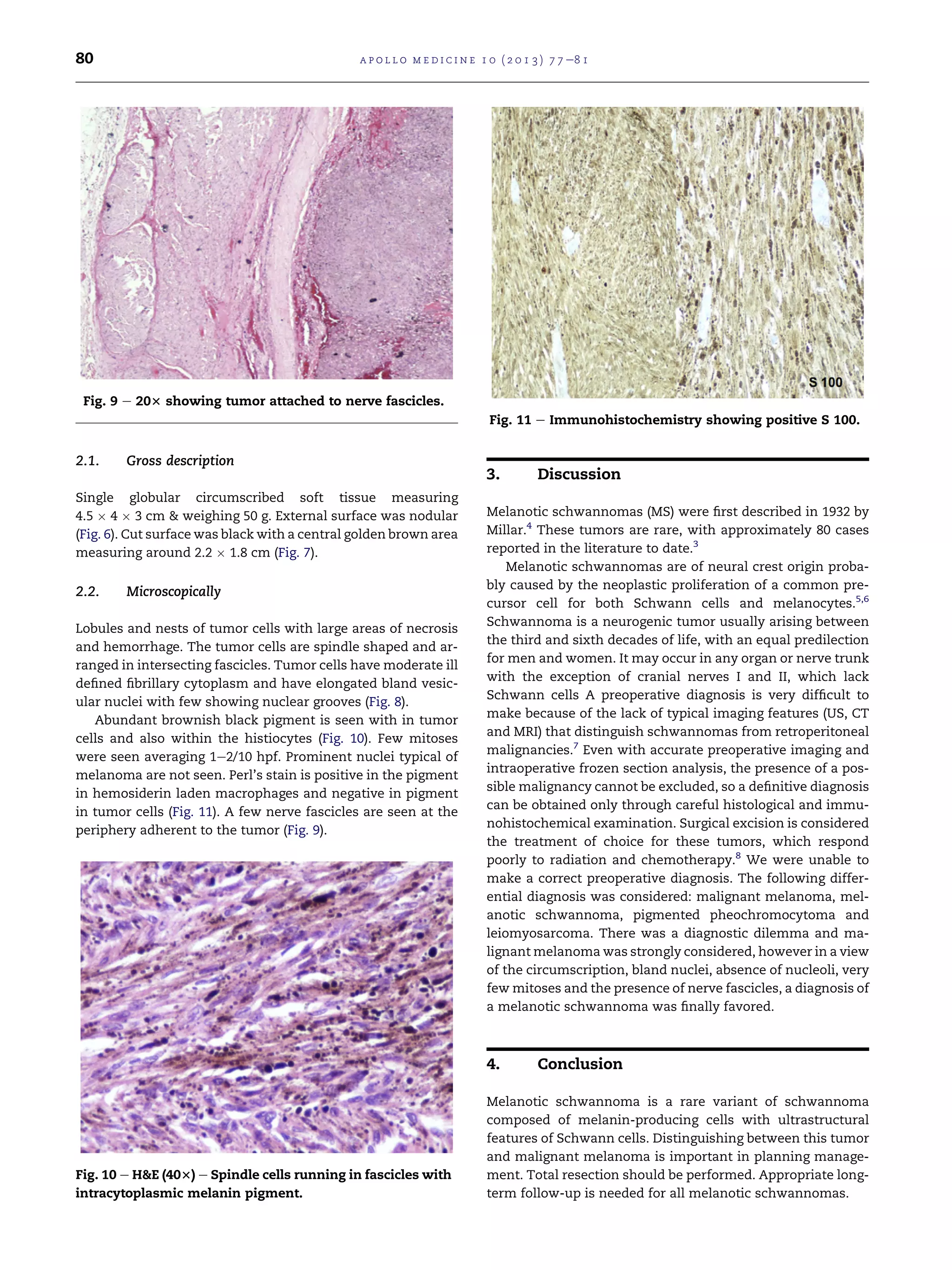 Melanotic Schwannoma of Adrenal Gland - A Rare Entity/ Diagnostic Dilemma | PDF