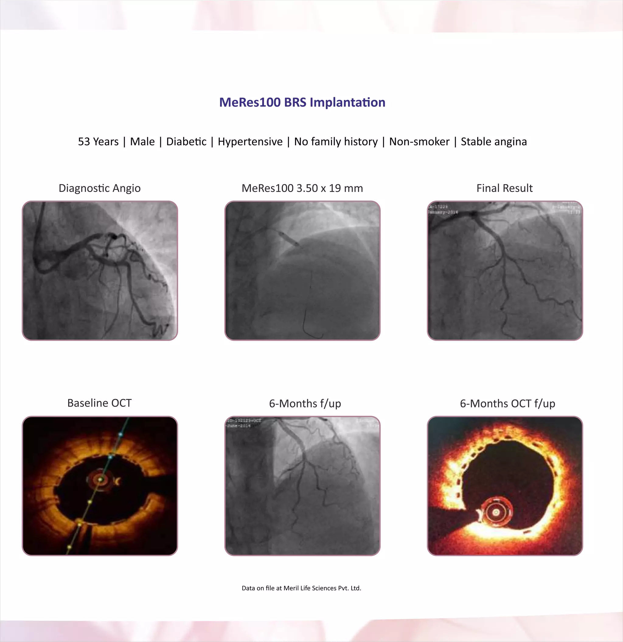 Explore the MeRes100, A Bioresorbable Scaffold Created by Meril Life | PDF