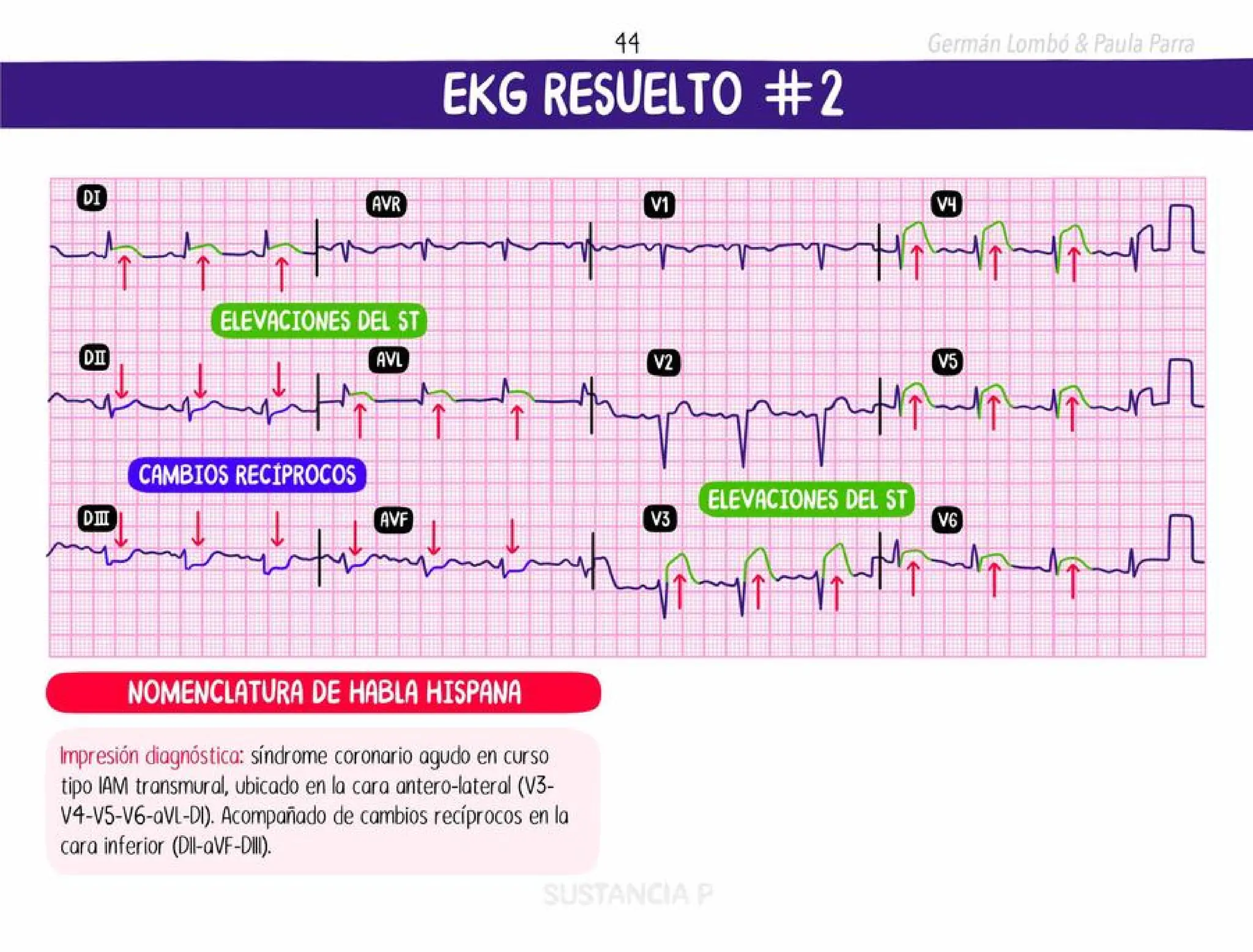 pdfcoffee.com_electrocardiograma-ecg-ekg-patologico-paula-parra ...