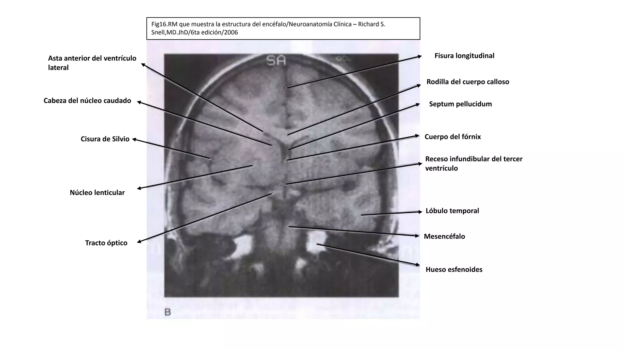 Corte de Flechsig y Charcot | PPTX