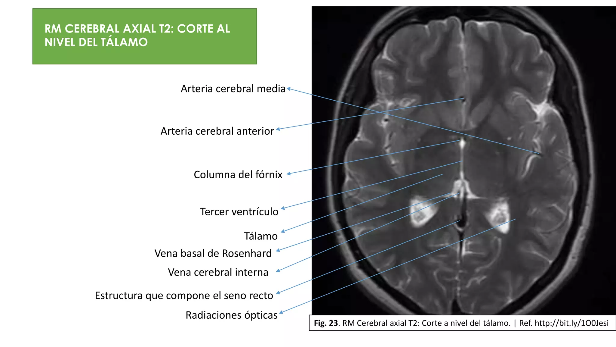 Corte de Flechsig y Charcot | PPTX