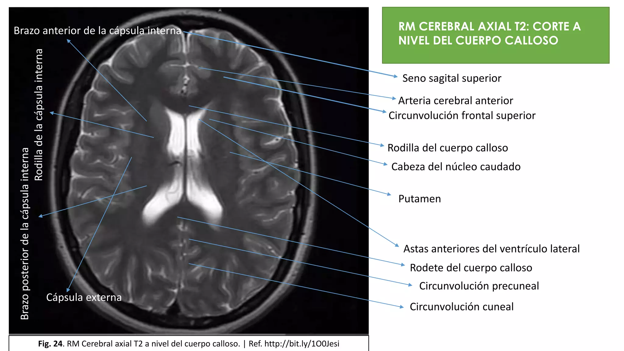 Corte de Flechsig y Charcot | PPTX