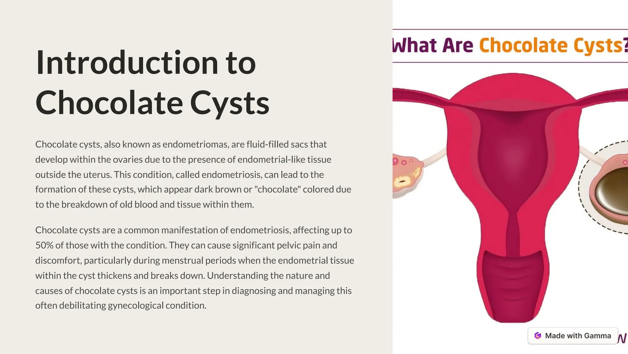 Ruptured chocolate cyst presentation ppt | PDF