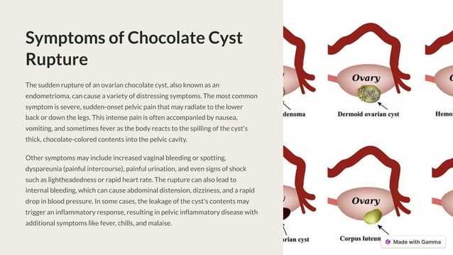 Ruptured chocolate cyst presentation ppt | PPT