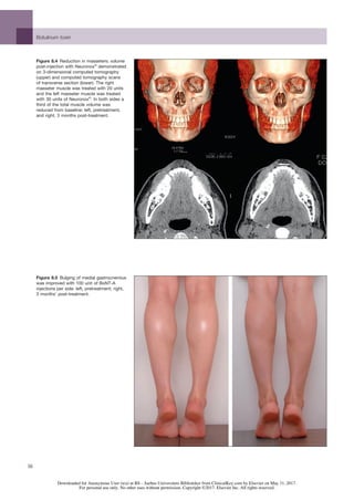 Meditoxin neuronox alternative Botox, which to buy online? | PDF