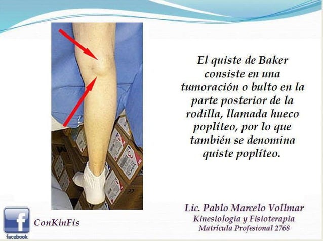 quiste poplíteo o quiste de Baker