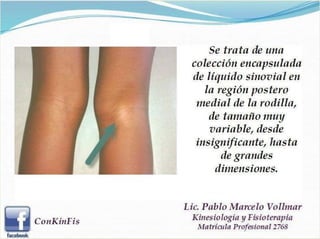 quiste poplíteo o quiste de Baker | PPT