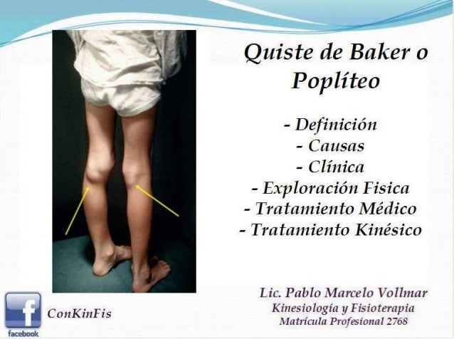 quiste poplíteo o quiste de Baker