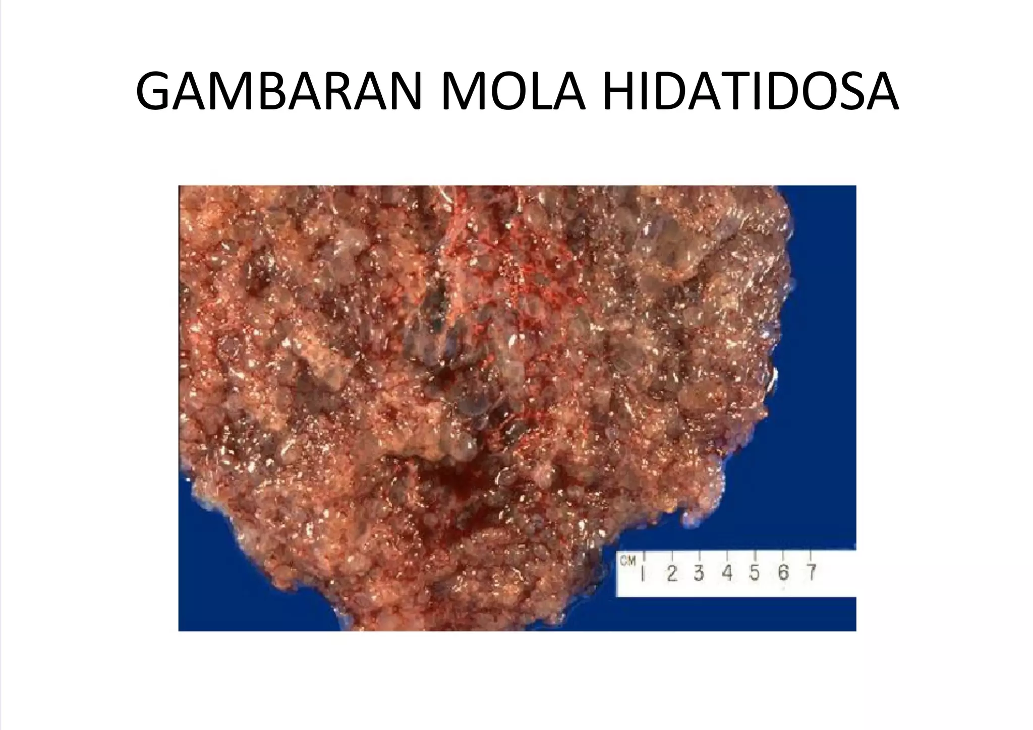 pdfslide.tips_ppt-mola-hidatidosappt.pdf