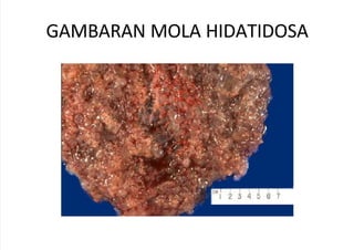pdfslide.tips_ppt-mola-hidatidosappt.pdf
