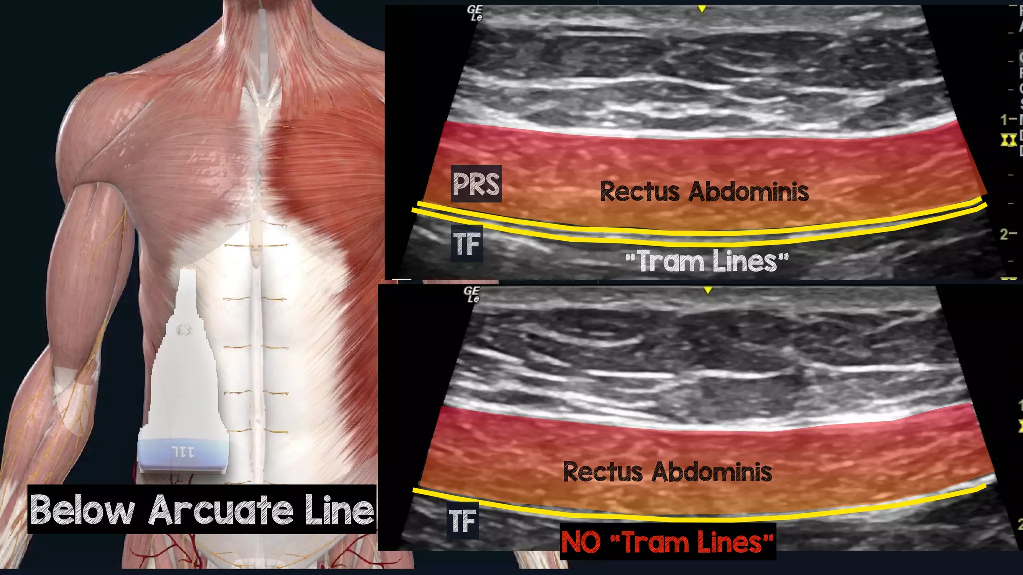 Trunk Blocks - Plan A Blocks - Royal College of Anaesthetists ...