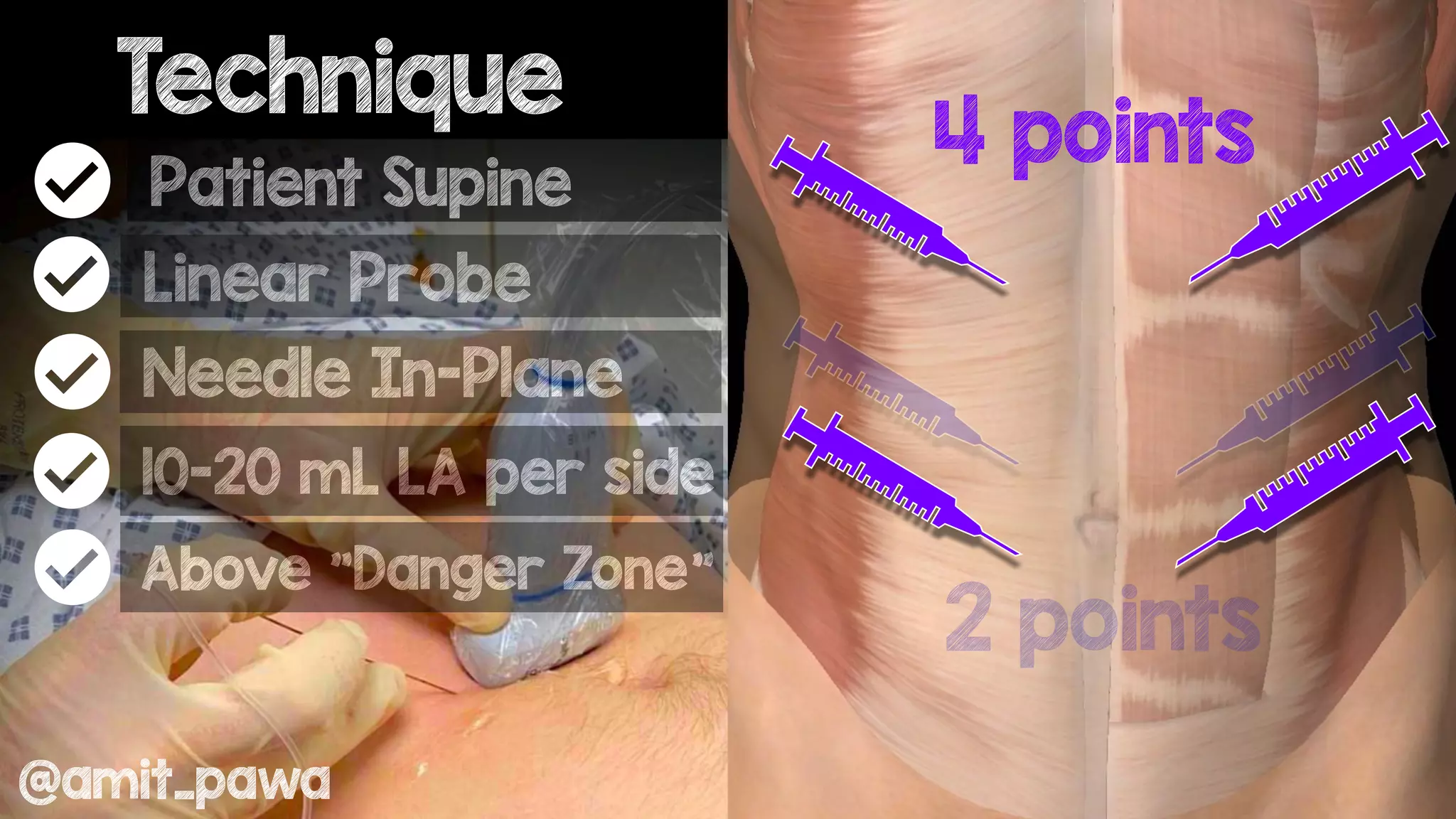 Trunk Blocks - Plan A Blocks - Royal College of Anaesthetists ...