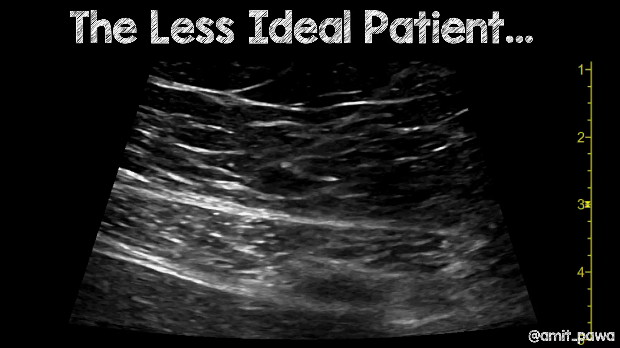 Trunk Blocks - Plan A Blocks - Royal College of Anaesthetists ...