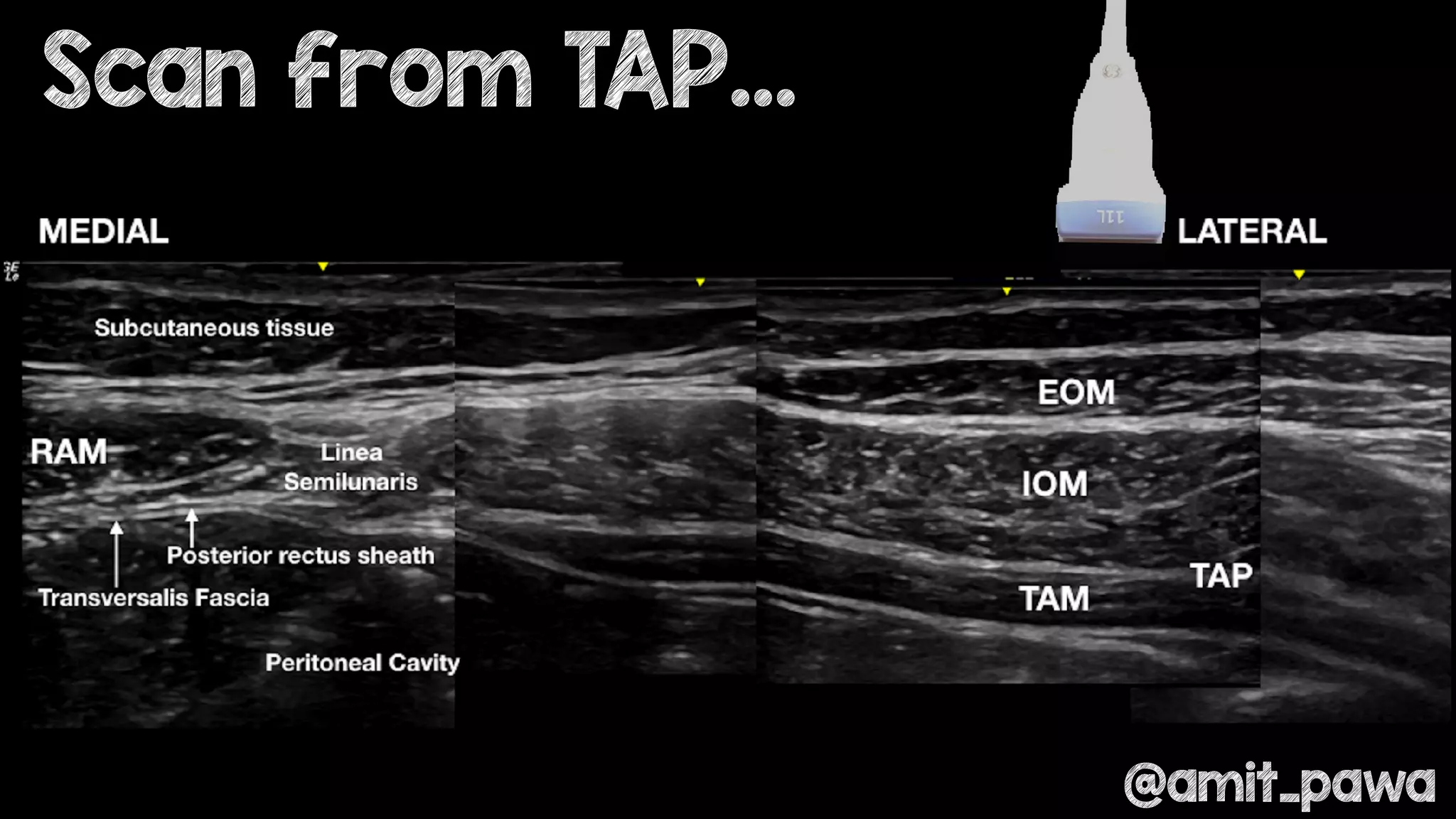 Trunk Blocks - Plan A Blocks - Royal College of Anaesthetists ...