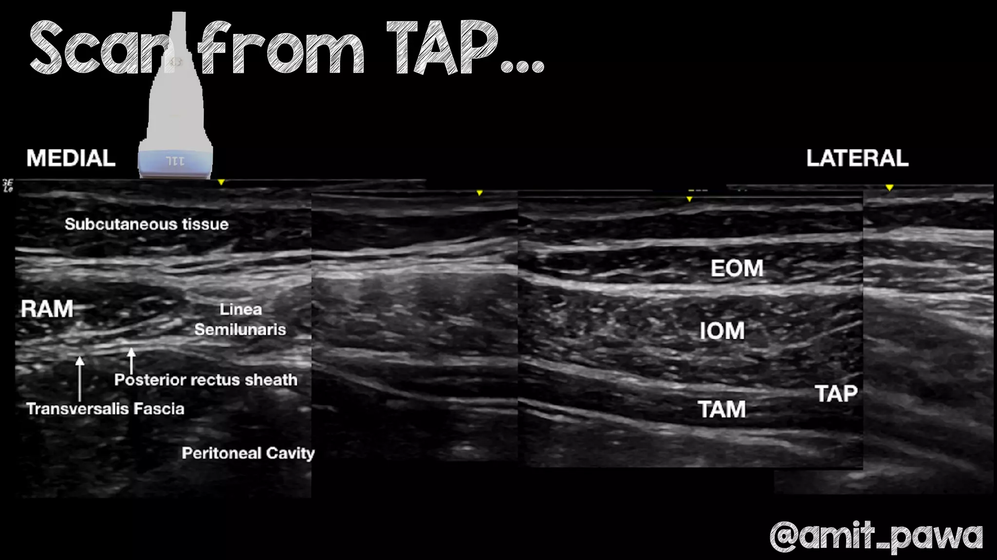 Trunk Blocks - Plan A Blocks - Royal College of Anaesthetists ...