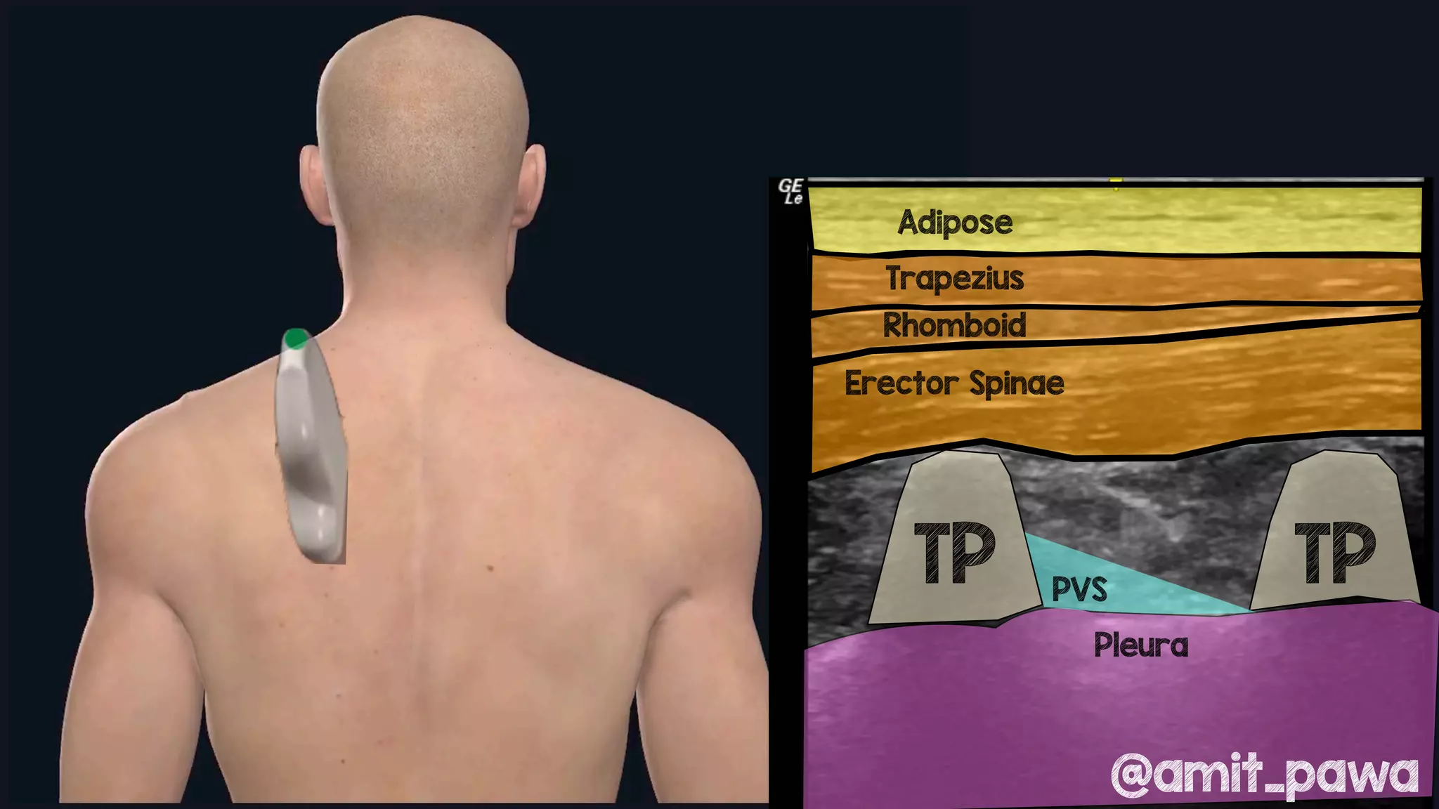 Trunk Blocks - Plan A Blocks - Royal College of Anaesthetists ...