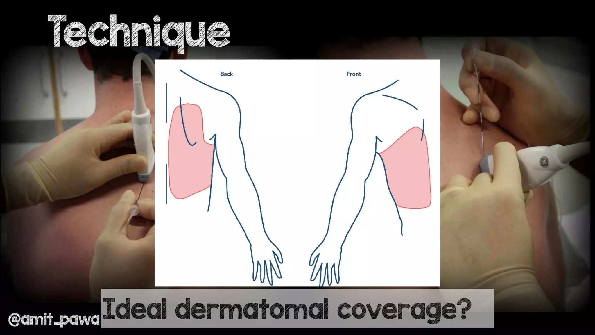 Trunk Blocks - Plan A Blocks - Royal College of Anaesthetists ...