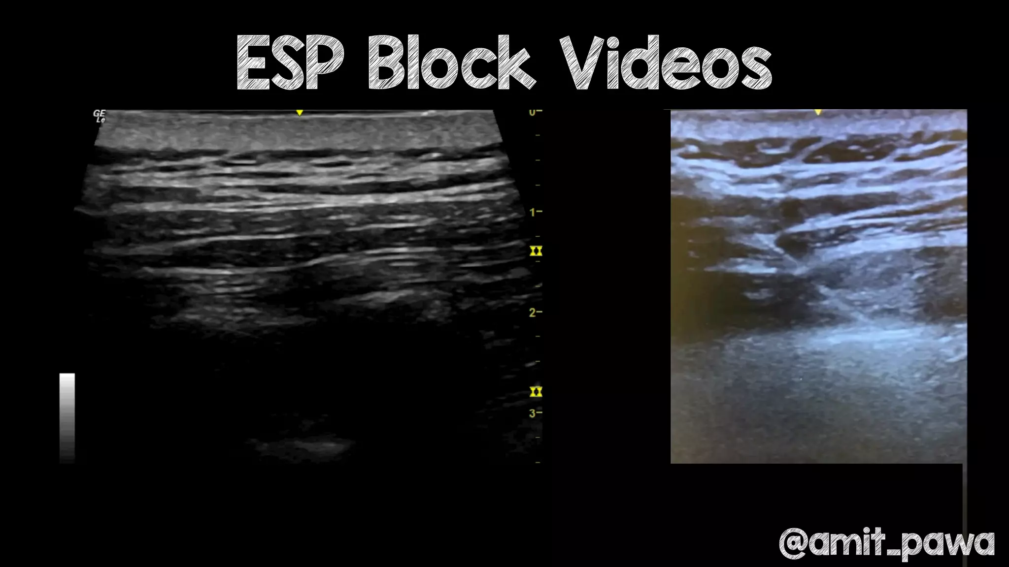 Trunk Blocks - Plan A Blocks - Royal College of Anaesthetists ...