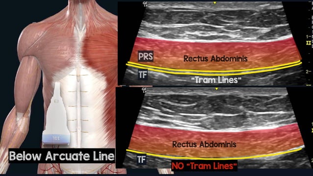 Trunk Blocks - Plan A Blocks - Royal College of Anaesthetists ...