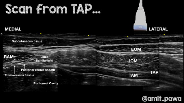 Trunk Blocks - Plan A Blocks - Royal College of Anaesthetists ...