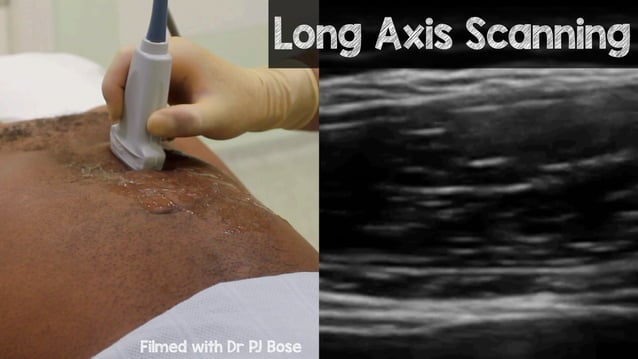 Trunk Blocks - Plan A Blocks - Royal College of Anaesthetists ...