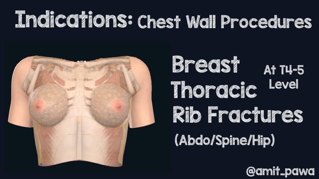Trunk Blocks - Plan A Blocks - Royal College of Anaesthetists ...