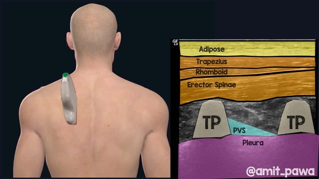 Trunk Blocks - Plan A Blocks - Royal College of Anaesthetists ...
