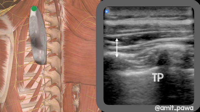 Trunk Blocks - Plan A Blocks - Royal College of Anaesthetists ...