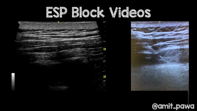 Trunk Blocks - Plan A Blocks - Royal College of Anaesthetists ...