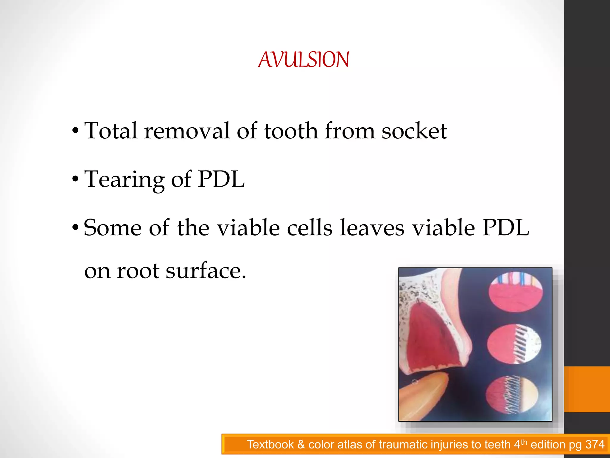 Periodontal ligament (PDL) | PPTX