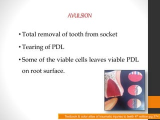 Periodontal ligament (PDL) | PPTX